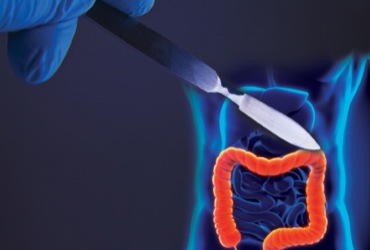 More Than Half of Colonoscopy-Related Perforations Lead to Surgery