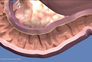 Endoscopic Approaches Emerging for Diabetes