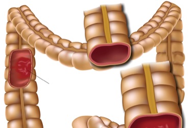 Ulcerative Colitis: An Update On Diagnosis and Treatment