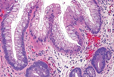 Meeting Seeks Common Ground on Intestinal Metaplasia