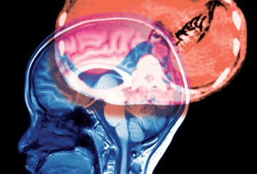 Management of Overt Hepatic Encephalopathy