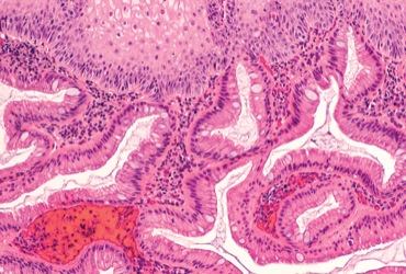 Endoscopic Assessment of Reflux: Are You Doing It Right?