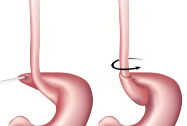 Nissen Fundoplication Or LINX for Gastroesophageal Reflux Disease?