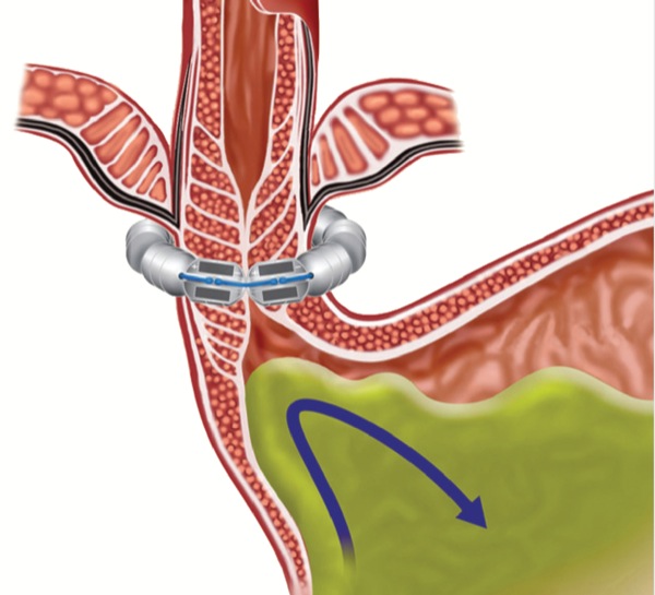 Nissen Fundoplication Or LINX for GERD