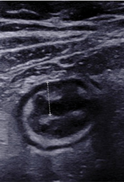 Intestinal Ultrasound in IBD: A Novel, Patient-Centered Monitoring Tool