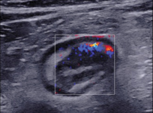 Intestinal Ultrasound in IBD