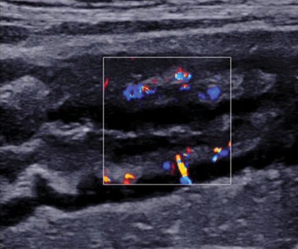 Intestinal Ultrasound in IBD: A Novel, Patient-Centered Monitoring Tool
