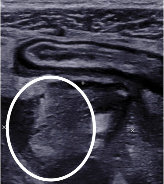 Intestinal Ultrasound in IBD: A Novel, Patient-Centered Monitoring Tool