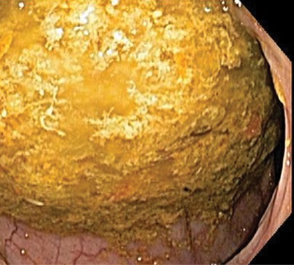 Bowel Preparation For Colonoscopy