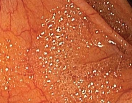 Bowel Preparation For Colonoscopy