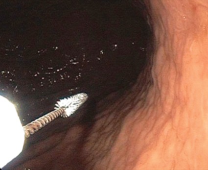 Recent Advances In Surveillance of Patients With Barrett’s Esophagus