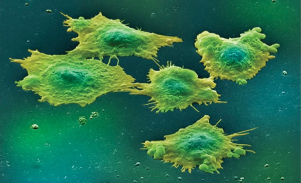 Immunoscore Validated for Colon Cancer