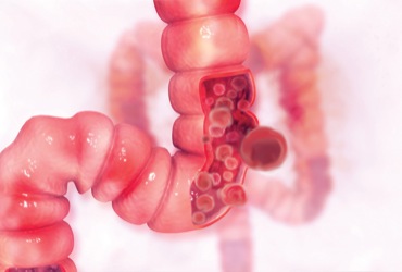 After Stage I CRC, Surveillance Colonoscopy Reduces Deaths