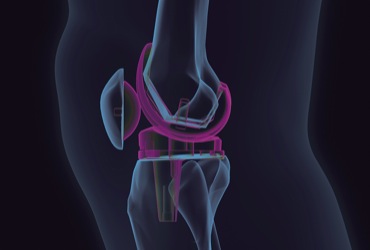 Treating Hepatitis C Improves Outcomes After Total Knee Replacement