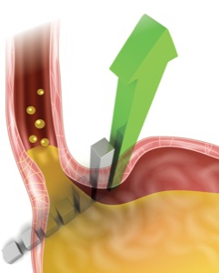 GERD Prevalence Rising