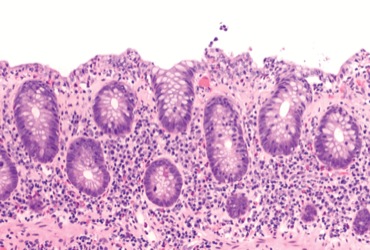 Study Finds Endoscopists May Miss Microscopic Colitis