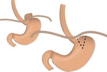 Collis Gastroplasty in Short Esophagus