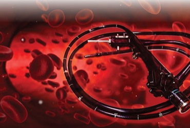 Criteria May Help Determine Bleeding Related to Colonoscopy