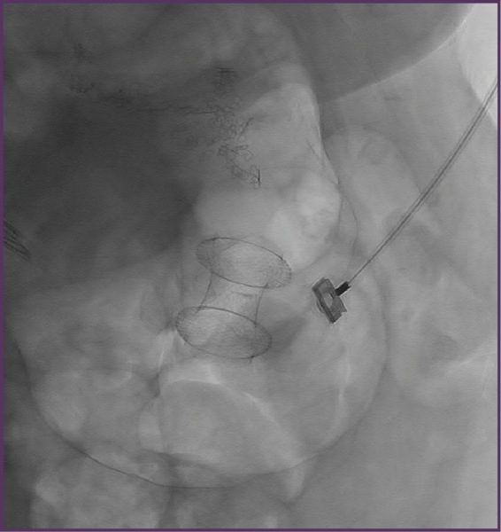 Therapeutic Endoscopic Ultrasound