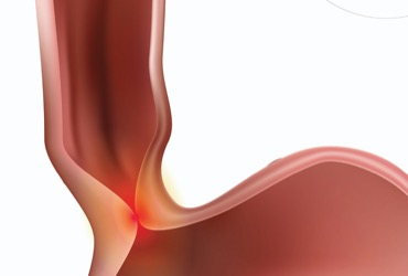 Laparoscopic Heller-Dor Procedure Appears To Cure Most Cases of Achalasia