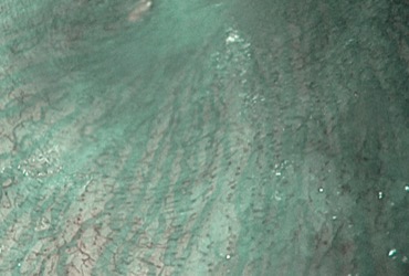 Narrow Band Imaging Shows Promise For Objective NERD Confirmation