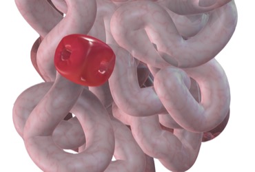 Preliminary Findings Confirm Suspicions About Pouch Failure in Peds