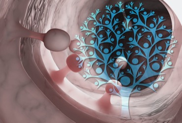 Family History of Polyps Raises CRC Risk