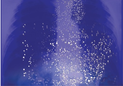 Enhanced TIF Procedure for GERD Confirms Benefit In Appropriate ...