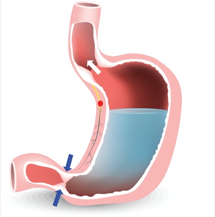 Functional Dyspepsia and Gastroparesis Called Same Disorder ...