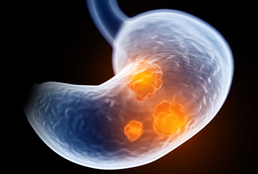 Keytruda Approved for First-Line Treatment of Advanced or Metastatic ...