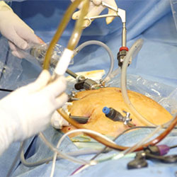 FDA Clears Endoscopic Hemostasis System, Nexpowder - Gastroenterology ...