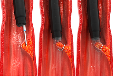 Cutting Depth Similar Between Underwater, Conventional EMR