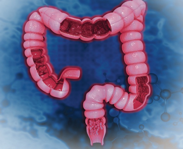 Sharma's Endoscopy Insights: Colorectal Polyps, EMR & Polypectomy ...