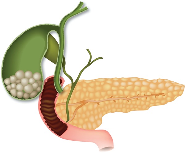 New Research Links Gallstones, Pancreatic Cancer - Gastroenterology ...