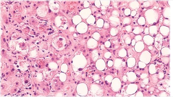Nonalcoholic Steatohepatitis: Identifying High-Risk Patients