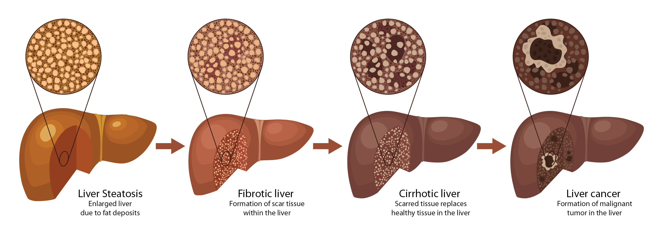 Nonalcoholic Steatohepatitis: Identifying High-Risk Patients