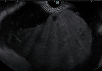 Endoscopy Ultrasound Therapeutic Endoscopic Ultrasound Tumor Surveillance