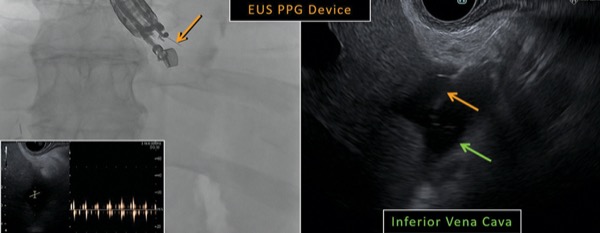 Endoscopy Ultrasound Therapeutic Endoscopic Ultrasound Tumor Surveillance