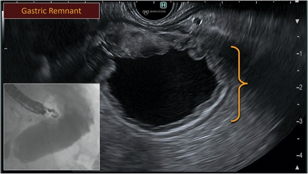 Endoscopy Ultrasound Therapeutic Endoscopic Ultrasound Tumor Surveillance