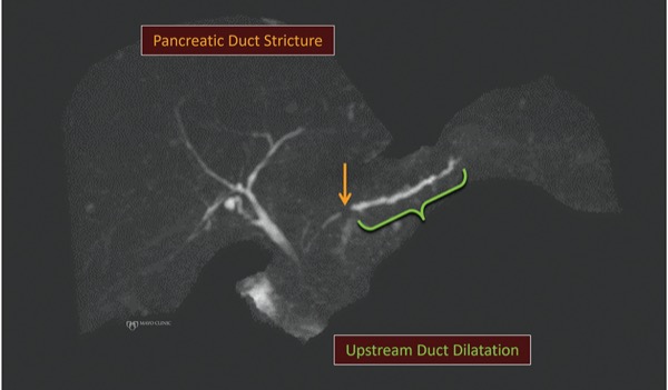 Case Studies From the Frontiers of Therapeutic Endoscopic Ultrasound in ...