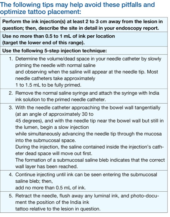 Placing the Optimal India Ink Tattoo - Gastroenterology & Endoscopy News