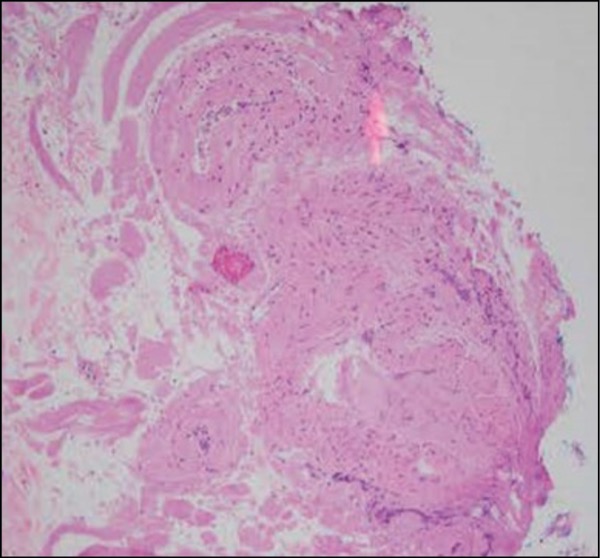Doppler Monitoring Can ID Delayed Post-Polypectomy Ulcer Bleeding ...