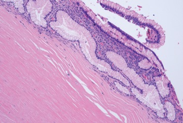 Pancreatic Cystic Lesions: A Case-Based Approach