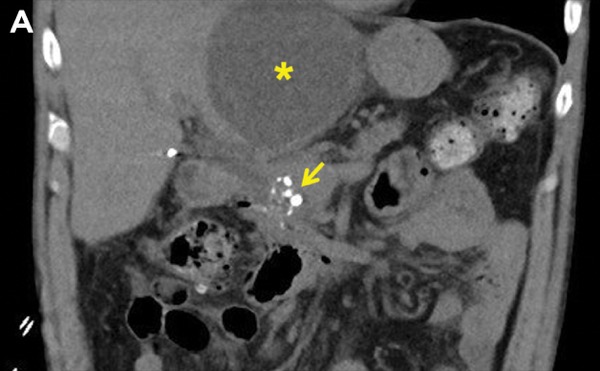 Pancreatic Cystic Lesions: A Case-Based Approach