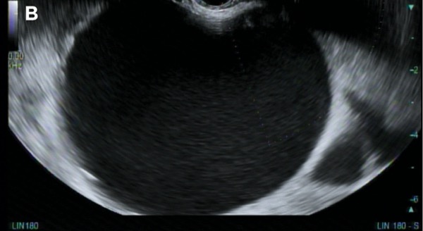 Pancreatic Cystic Lesions: A Case-Based Approach