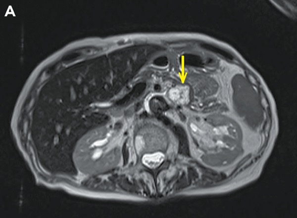 Pancreatic Cystic Lesions: A Case-Based Approach
