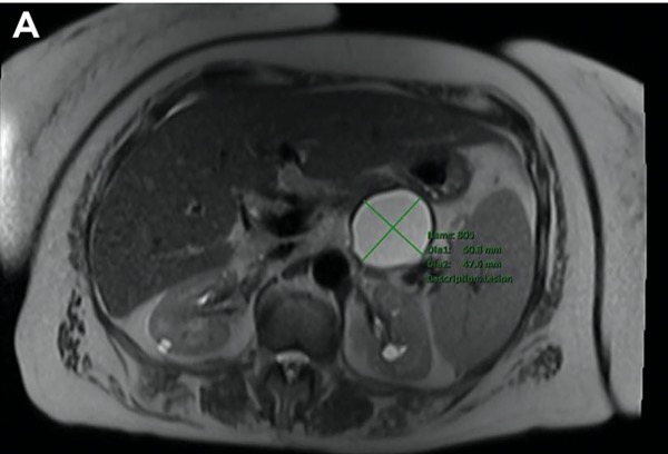 Pancreatic Cystic Lesions: A Case-Based Approach