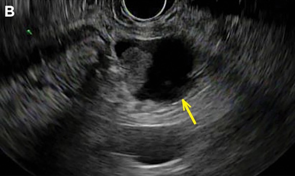 Pancreatic Cystic Lesions: A Case-Based Approach