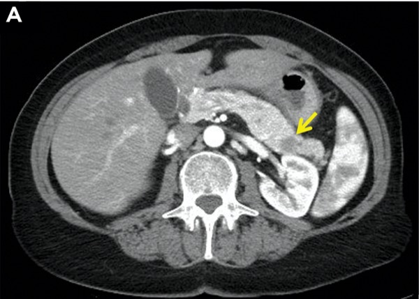 Pancreatic Cystic Lesions: A Case-Based Approach