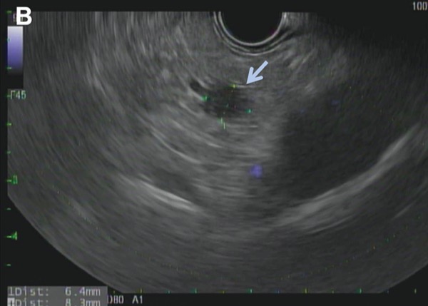 Pancreatic Cystic Lesions: A Case-Based Approach